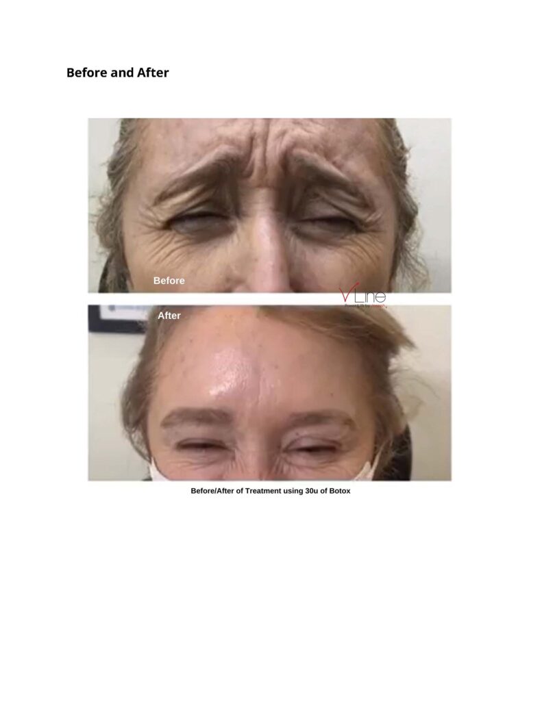 Basic Botox Training Program | V-Line Aesthetics