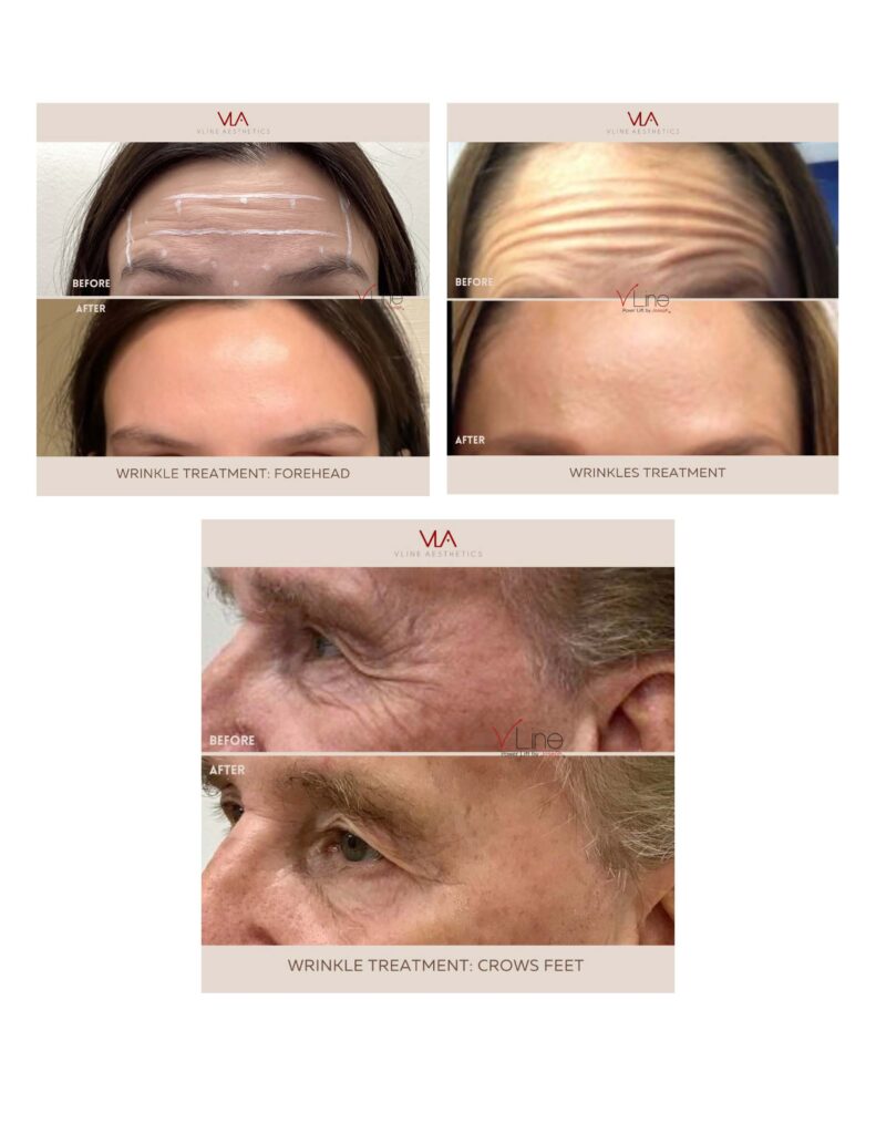 Basic Botox Training Program | V-Line Aesthetics