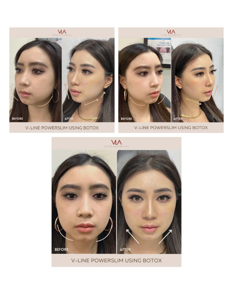 Basic Botox Training Program | V-Line Aesthetics