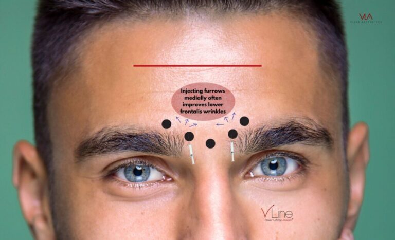 Botox Training Program - Basic | V-Line Aesthetics