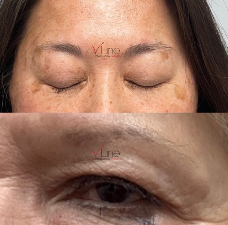 Botox Training Program - Basic | V-Line Aesthetics