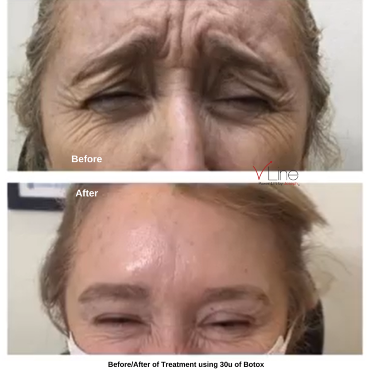 Botox Training Program - Basic | V-Line Aesthetics