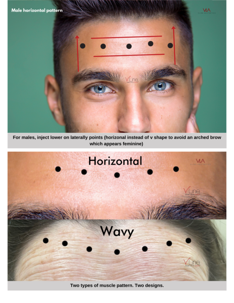Botox Training Program - Basic | V-Line Aesthetics
