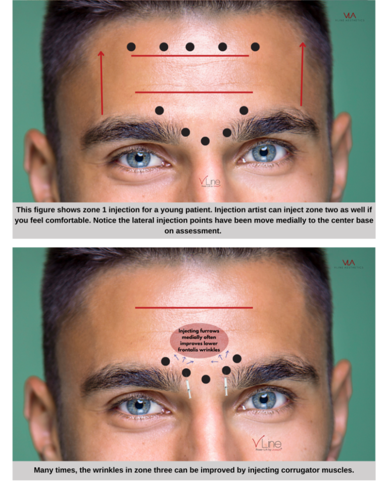 Botox Training Program - Basic | V-Line Aesthetics