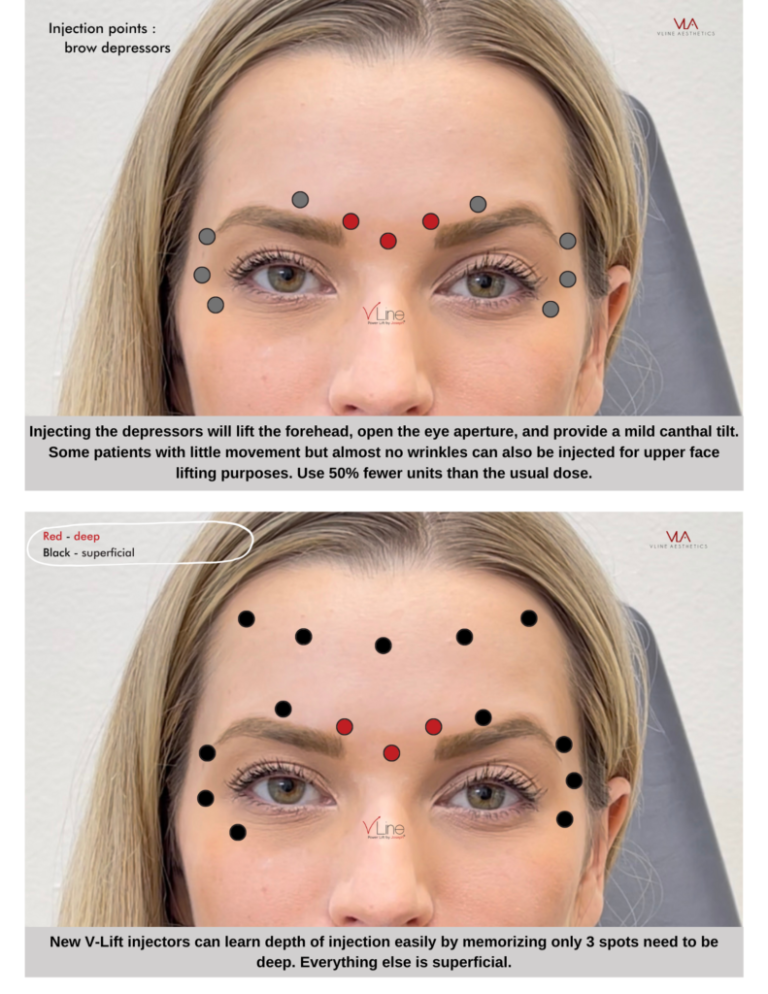 Botox Training Program - Basic | V-Line Aesthetics