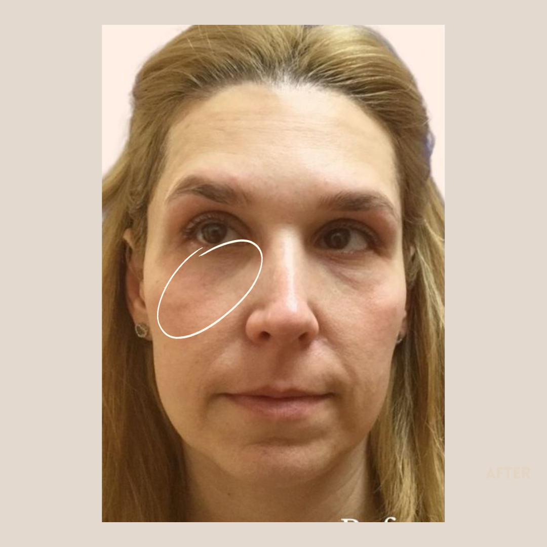 V-Line Series Training Program - Basic | V-Line Aesthetics