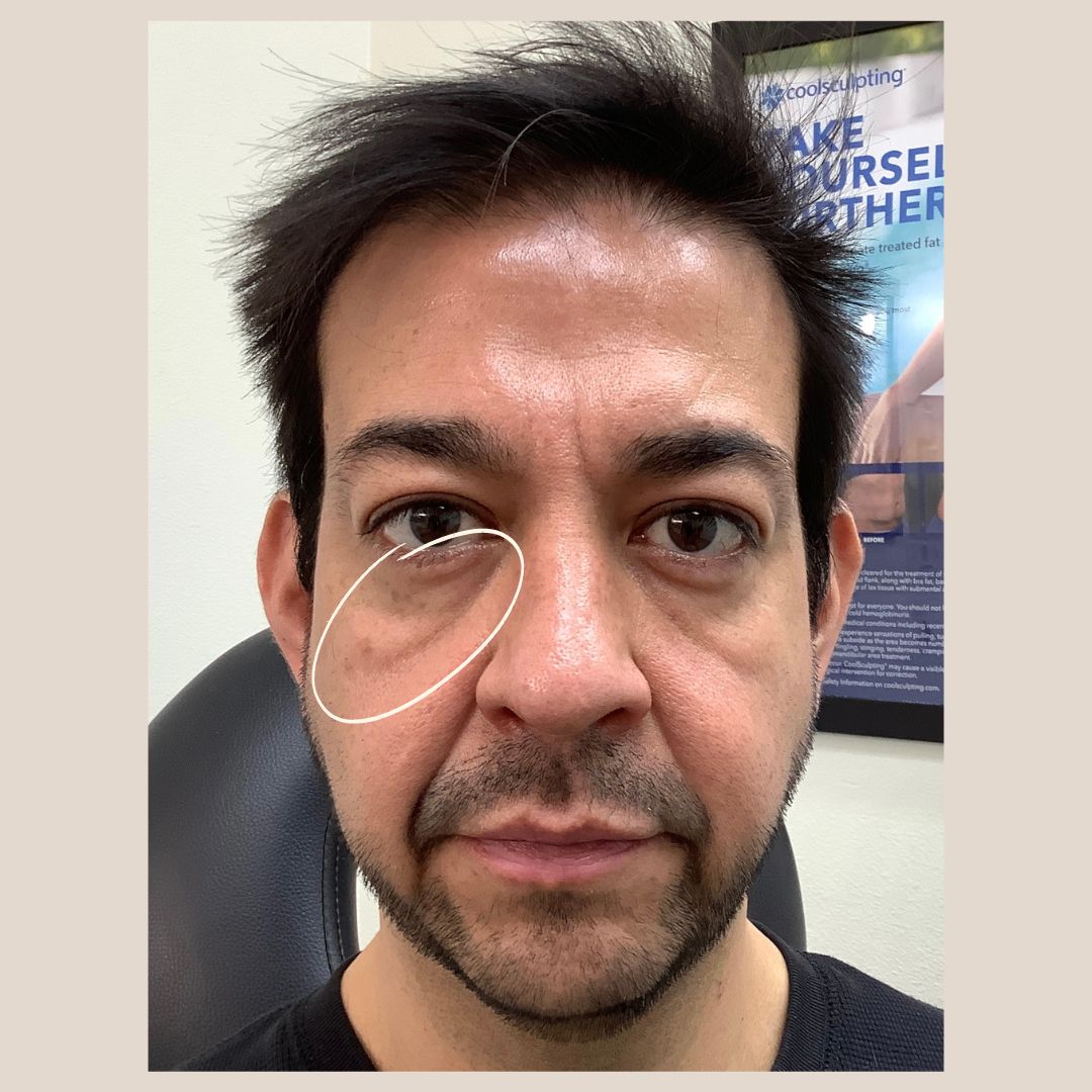 V-Line Series Training Program - Basic | V-Line Aesthetics